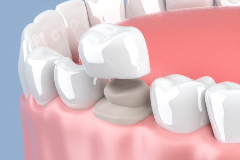 Top Tips to Maintain Your Dental Crown for Years